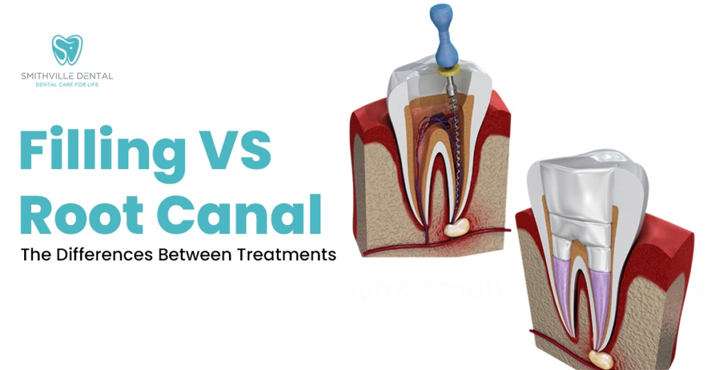 Filling VS Root Canal – The Differences Between Treatments